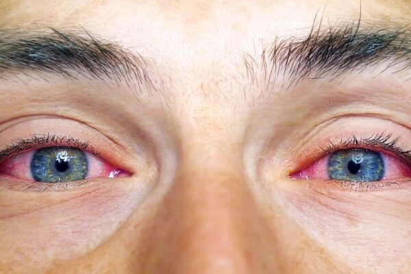 Apa itu Konjungtivitis - Varash Malang (+628121737190)